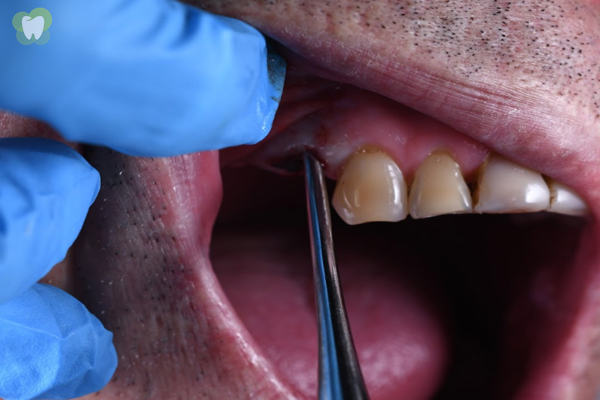 Extracción Dental - Clinica Dental en Osorno Extracción Dental - Clinica Dental en Osorno
